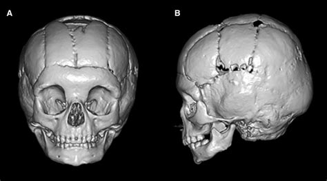Three Dimensional Computed Tomography Imaging 6 Months Postoperative Download Scientific