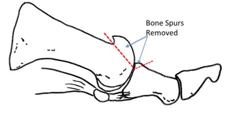 Surgeries First Mtp Joint Cheilectomy — Adrian Talia