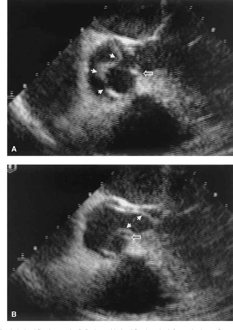 Figure 1 From Proximal Prolapse Of Aortic Intimal Flap A Rare Complication Of Acute Type A