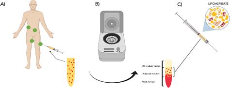 Figure 1 From Scarring And Skin Fibrosis Reversal With Regenerative Surgery And Stem Cell