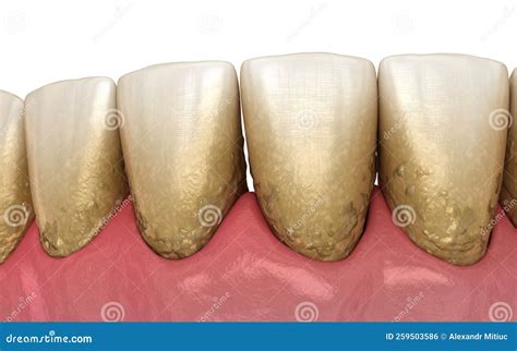 Tartar And Bactrail Tooth Plaque Lower Jaw Medically Accurate 3d