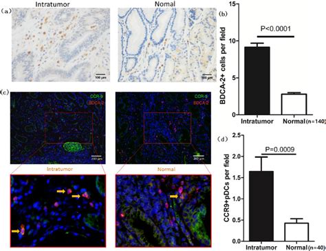 Dominant Infiltration Of Bdca 2 Pdcs In Carcinoma Tissue And A Great