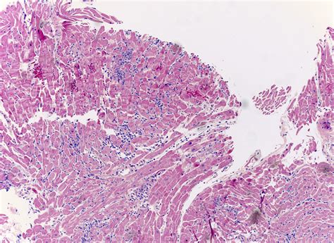 Pathology Outlines Acute Cellular Rejection