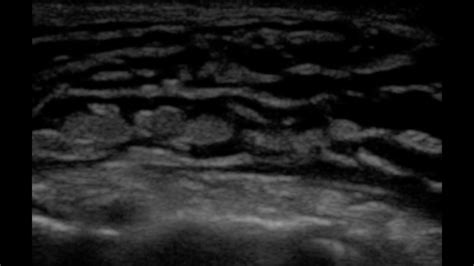 Abscess Internet Book Of Msk Ultrasound