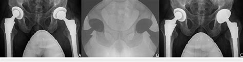 management of left hip recurrent dislocation a ap radiograph in a
