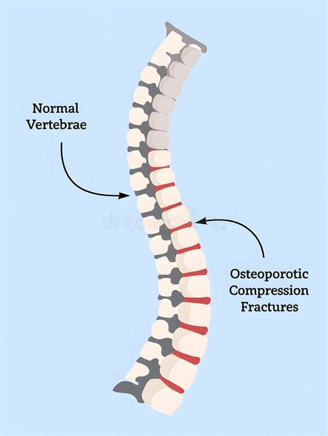 Illustration Of Normal Vertebrae Compared To Osteoporotic Compression