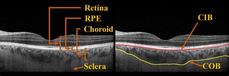 sample oct b scan depicting various posterior segment layers left and