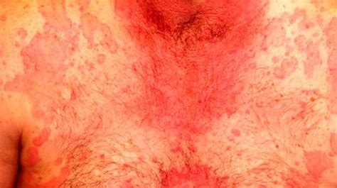 Aquagenic Urticaria Oorzaken Symptomen En Behandeling Medische