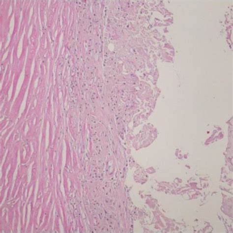 Parenchymal Distortion Together With Pleomorphic Calcifications
