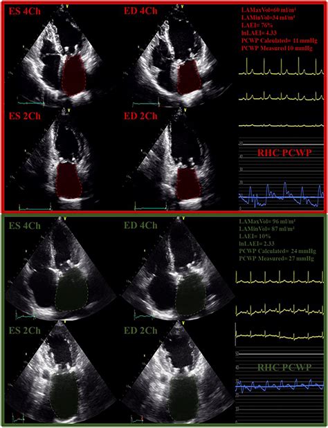 Mv Bioprosthesis Patients With Normal Top And Elevated Bottom Pcwp
