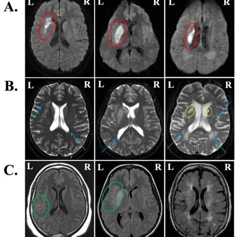 Lesion Overlap Maps Of A Acute Stroke Lesions And B Prior Stroke Download Scientific Diagram