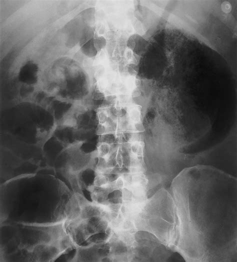 Intravenous Urography Radiology Reference Article Radiopaediaorg