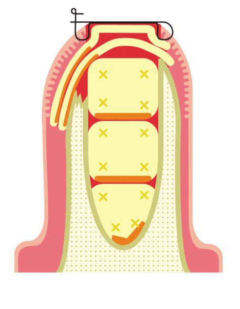 Graphic Representation Of An Extraction Socket Filled With L Prf