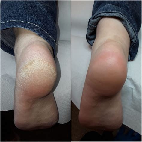 Odciski Modzele Zrogowacenia Instytut Zdrowej Stopy