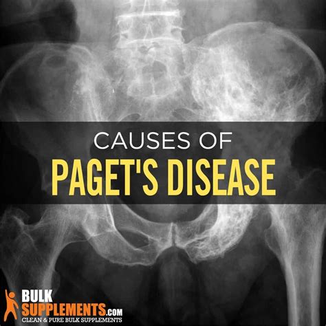 Pagets Disease Causes And Treatment At Sherlyn Weyer Blog
