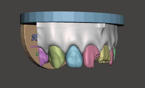3d Dental Custom Model Anterior Class Iv And Class Vi Segmented 3d