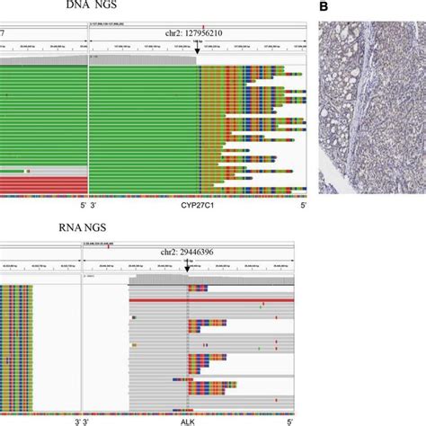 Multiple Methods Were Used To Detect Alk Fusions In The Surgical
