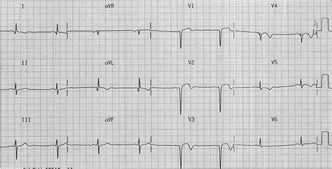 Left Ventricular Lv Aneurysm Ecg