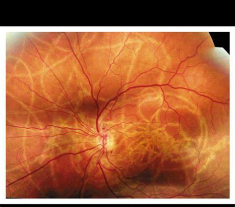 Ocular Myiasis Medizzy