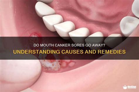 Do Mouth Canker Sores Go Away Understanding Causes And Remedies Medshun