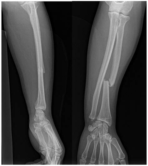 Advancements In Diagnosis And Management Of Distal Radioulnar Joint