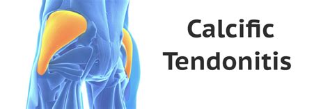 Calcific Tendonitis Of Gluteus Medius Muscle Michiro
