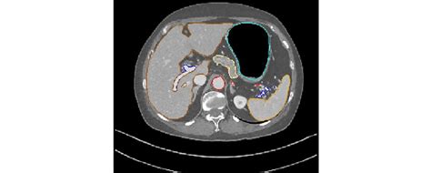 Multi Organ Segmentation In Ct Axial Figure Reproduced From 77 Download Scientific Diagram