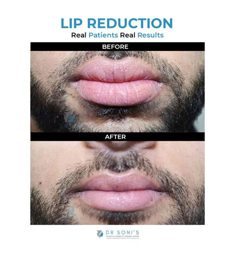 Lip Reduction Surgery Lip Thinning Surgery In Panipat Haryana