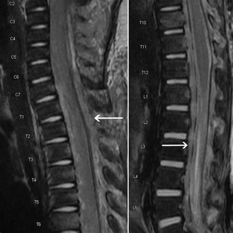 interval t2 mri following initial decompression with recurrent residual