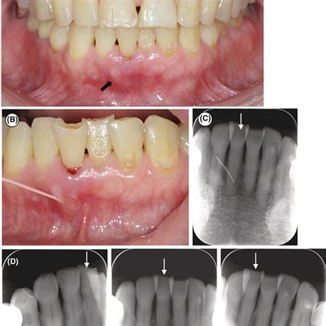 Pdf Successful Regenerative Response Of A Severe Bone Defect In A
