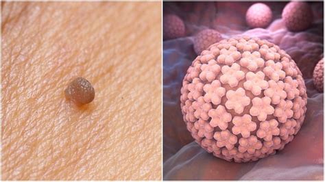 Как удалить папилломы