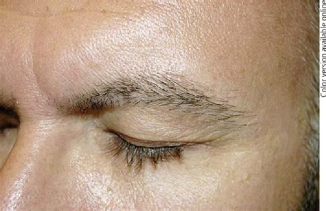 Syphilitic Alopecia Semantic Scholar