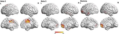Increased Resting State Eeg Activity Red For Alcohol Addicted