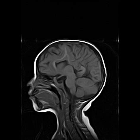 Middle Interhemispheric Variant Of Holoprosencephaly Pacs