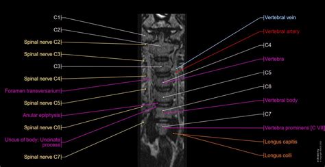 Cervical Spine Mri Normal Anatomy E Anatomy