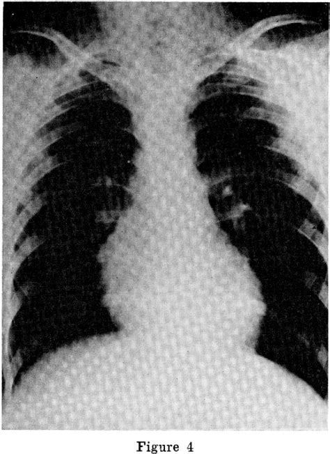 Supravalvular Aortic Stenosis Semantic Scholar