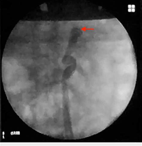 Retrograde Pyelography Performed Via The Cut End Of The Ureter In The