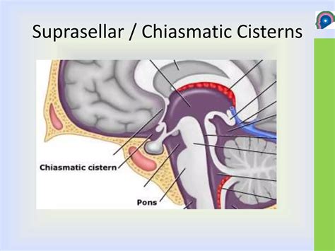 Cisterns Of Brain Pptx Brain And Nervous System Disorders Diseases And Conditions