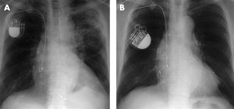 Biventricular Pacemaker Chest X Ray
