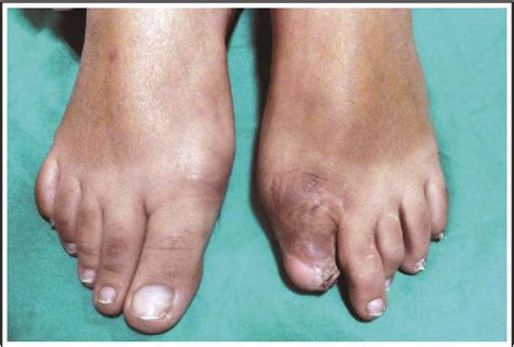 Figure 2 From Prosthetic Rehabilitation Of Amputated Hallux After Distraction Osteogenesis One