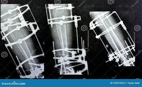 Distal Comminuted Fracture Fibula Managed By Plate And Screws Distal