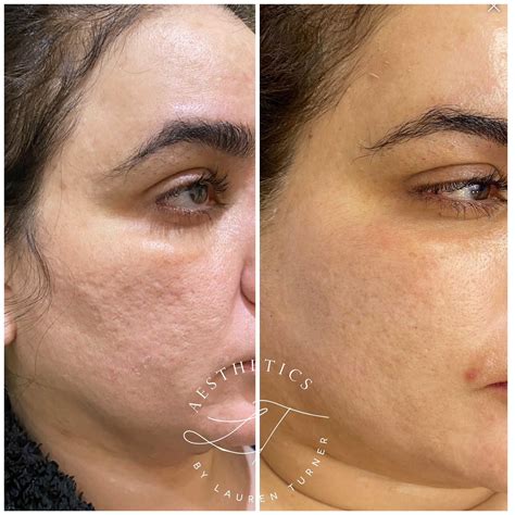 Does Microneedling Work Glowday