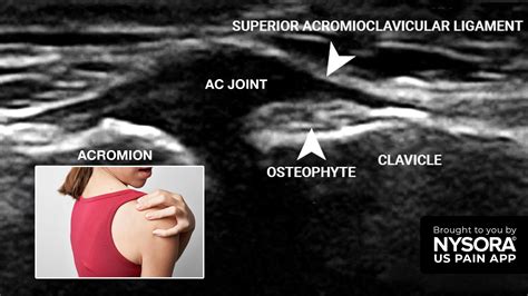 Acromioclavicular Joint Acromioclavicular Joint Anatomy Earths