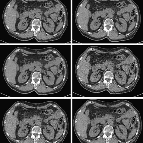 Méthode De Reconstruction Itérative Sinogram Affirmed Iterative