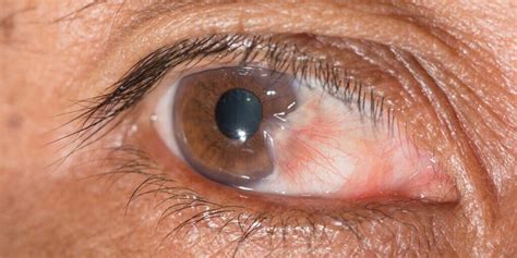 Surfers Eye Isnt Just For Surfers How To Avoid Pterygium Eye Growths