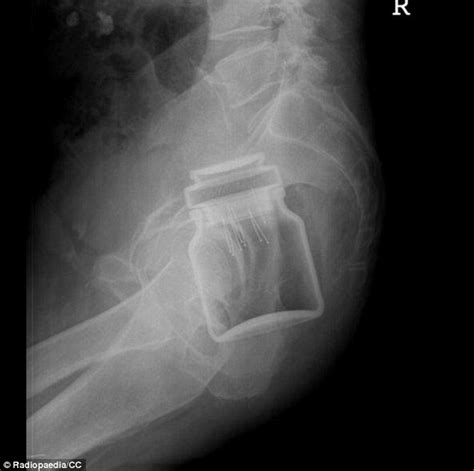 Doctors Share X Rays Of The Strangest Things They Ve Found Stuck In People S Rears Daily Mail