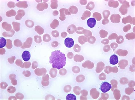 Lymphoid Malignancies Ch 13 Flashcards Quizlet