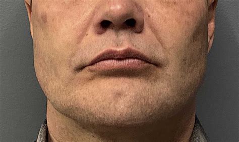 Male Custom Jawline Implants Front 2 Dr Barry Eppley Explore Plastic