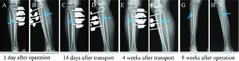 These Postoperative Radiographs Show A Tibia That Underwent Ttt A B Download Scientific