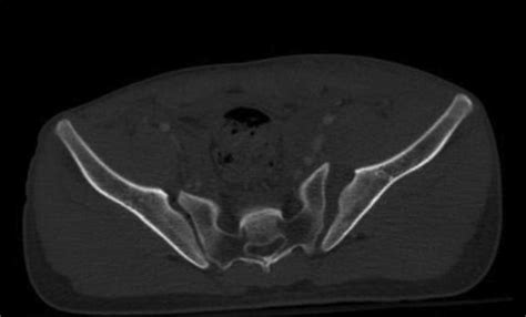 Pelvic Ring Fractures Trauma Orthobullets